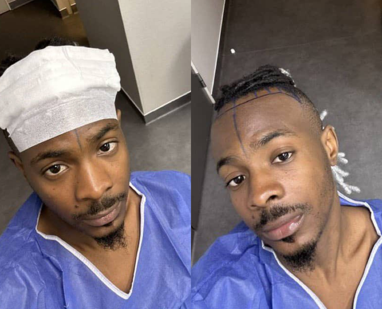 Young Jonn undergoes hair transplant surgery - P.M. News